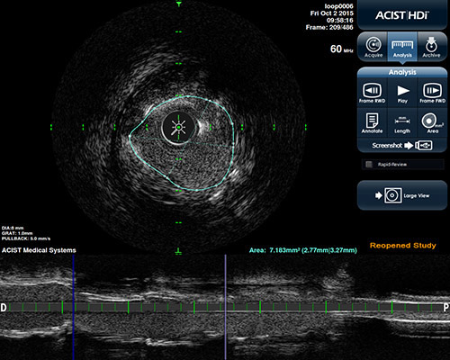In-Stent-Restenose (ISR) der A. coronaria dextra (ACD) | ACIST HDi Case ...