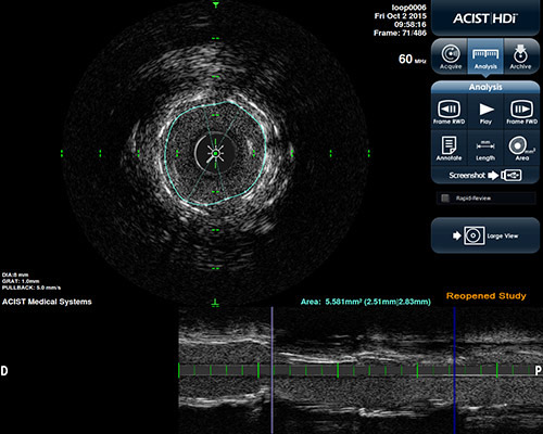In-Stent-Restenose (ISR) der A. coronaria dextra (ACD) | ACIST HDi Case ...
