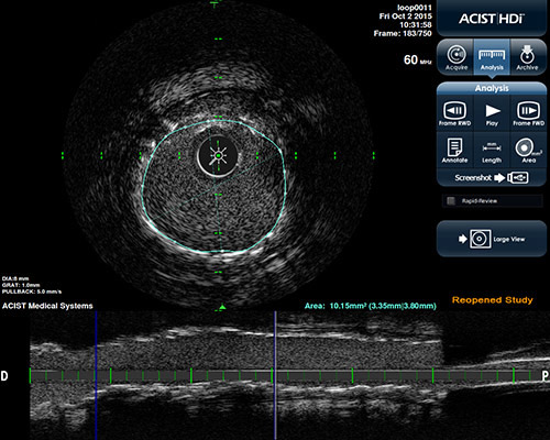 In-Stent-Restenose (ISR) der A. coronaria dextra (ACD) | ACIST HDi Case ...